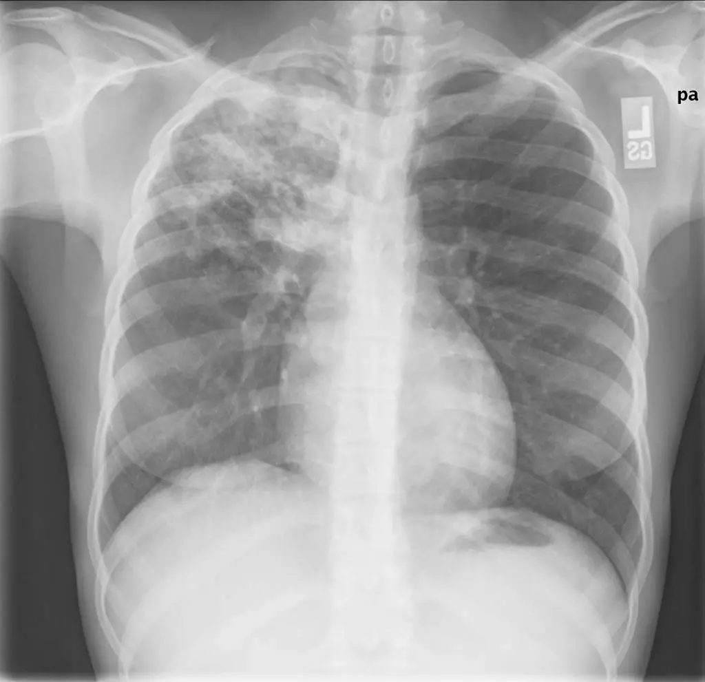 Tuberculoza pulmonara | Pneumologie Galati